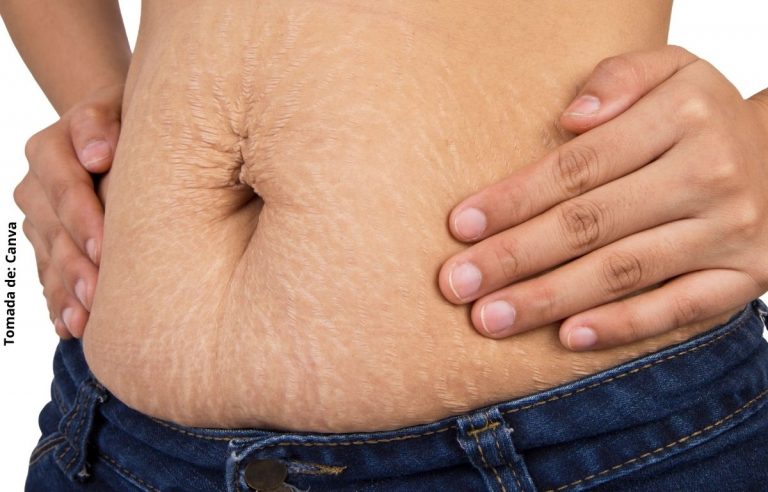¿Cómo quitar las estrías?, tratamientos y remedios caseros